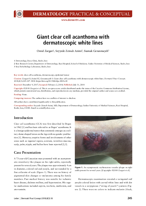 (PDF) Giant clear cell acanthoma with dermatoscopic white lines