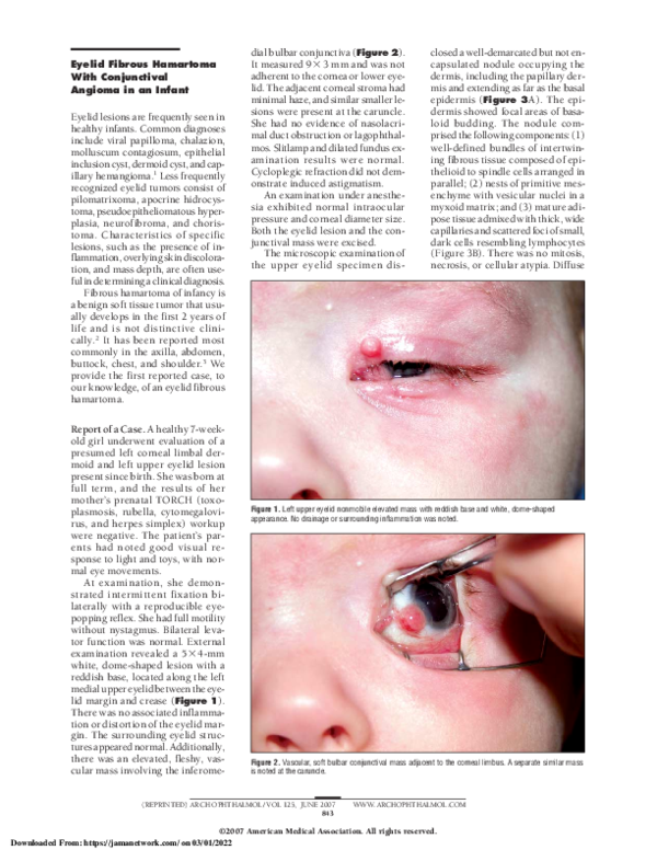 (PDF) Eyelid Fibrous Hamartoma With Conjunctival Angioma in an Infant ...