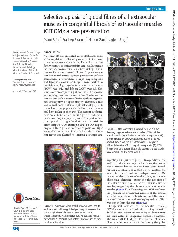 (PDF) Selective aplasia of global fibres of all extraocular muscles in ...