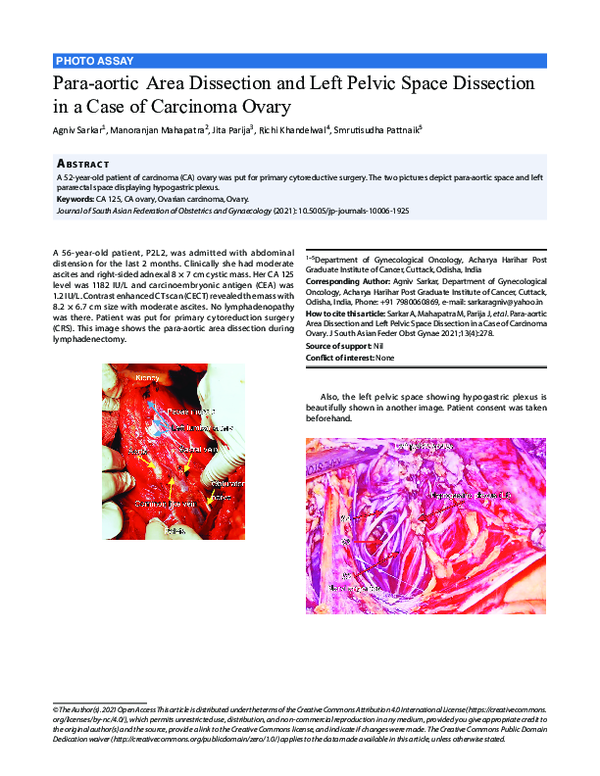(PDF) Para-aortic Area Dissection and Left Pelvic Space Dissection in a ...