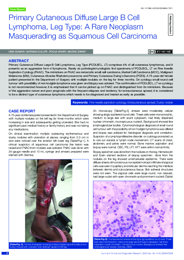 (PDF) Primary Cutaneous Diffuse Large B Cell Lymphoma, Leg Type: A Rare ...