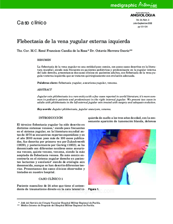 (PDF) Flebectasia de la vena yugular externa izquierda