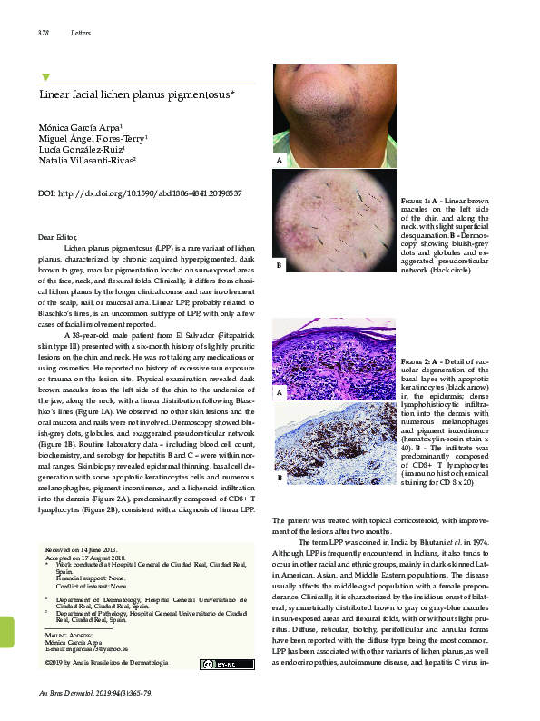 (PDF) Linear facial lichen planus pigmentosus