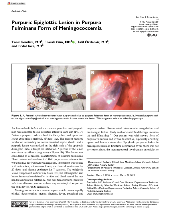 (PDF) Purpuric Epiglottic Lesion in Purpura Fulminans Form of ...