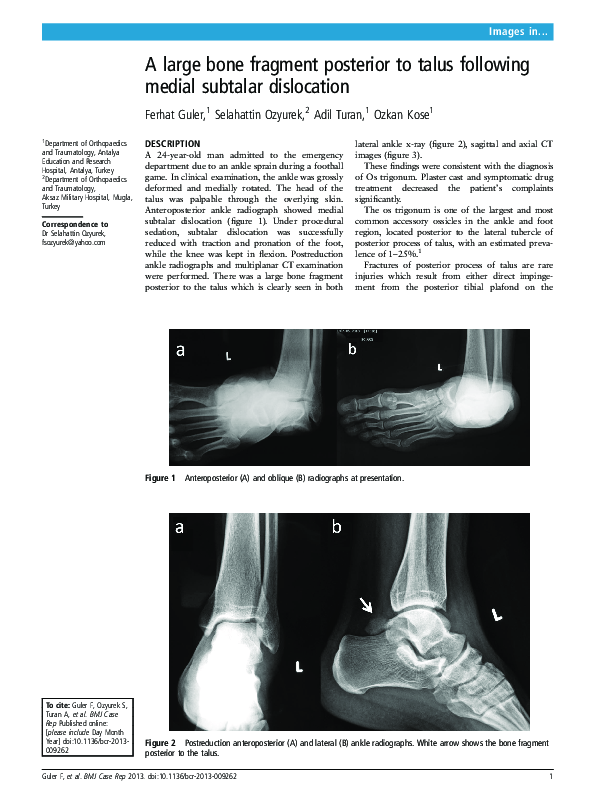 (PDF) A large bone fragment posterior to talus following medial subtalar dislocation