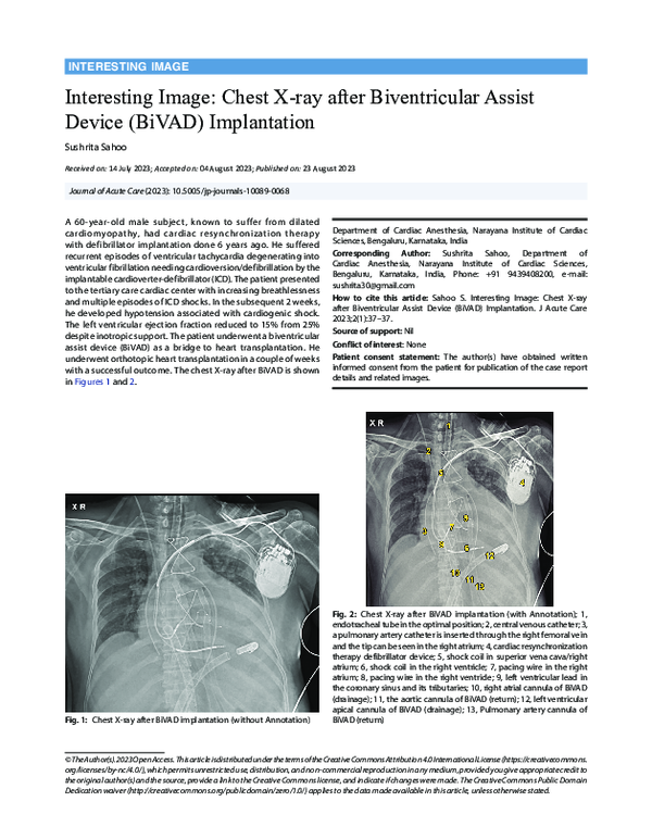 (PDF) Interesting Image: Chest X-ray after Biventricular Assist Device ...