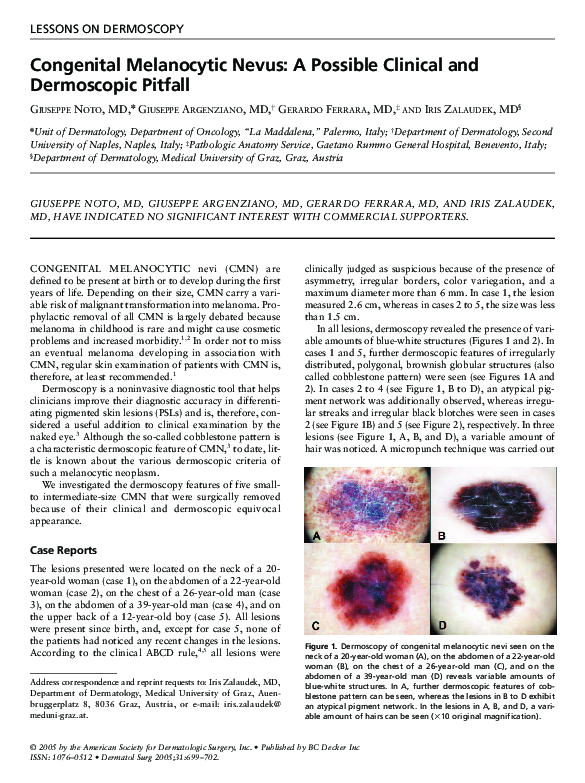 (PDF) Congenital Melanocytic Nevus: A Possible Clinical and Dermoscopic ...