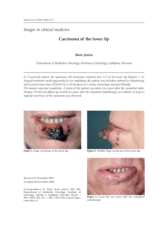 (PDF) Carcinoma of the lower lip