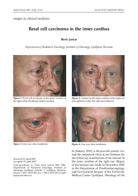 (PDF) Basal cell carcinoma in the inner canthus