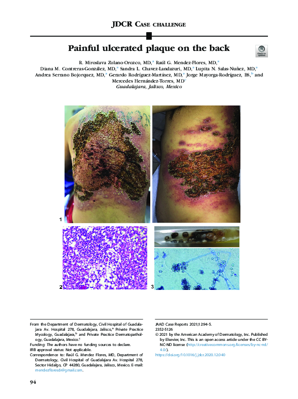 (PDF) Painful ulcerated plaque on the back