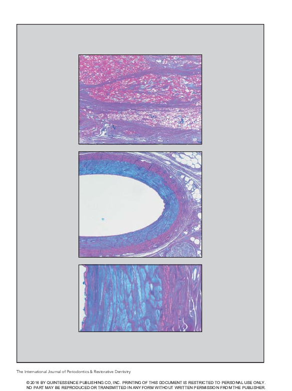 (PDF) Tissue Integration of a Volume-Stable Collagen Matrix in an ...
