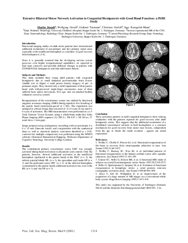 (PDF) Extensive Bilateral Motor Network Activation in Congenital ...