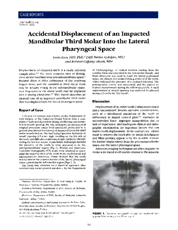 (PDF) Accidental displacement of an impacted mandibular third molar ...