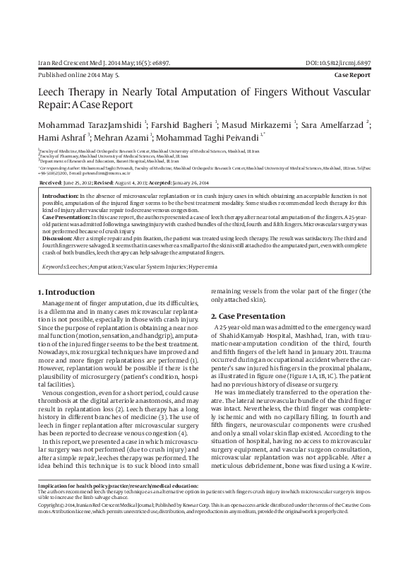 (PDF) Leech Therapy in Nearly Total Amputation of Fingers Without ...