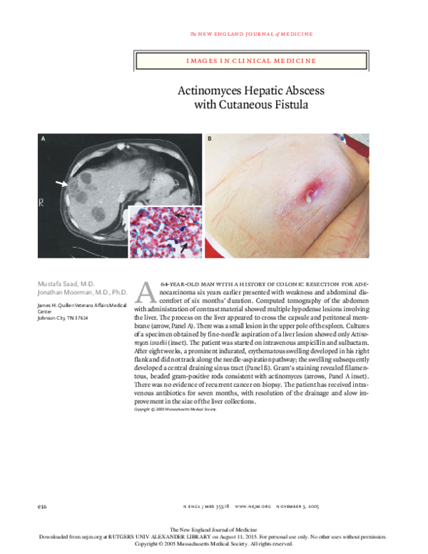 (PDF) Actinomyces Hepatic Abscess with Cutaneous Fistula