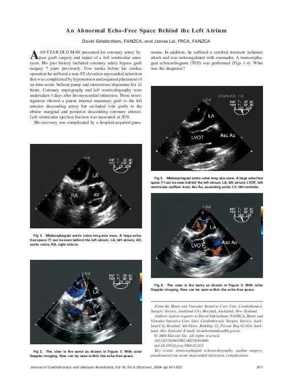 (PDF) An abnormal echo-free space behind the left atrium