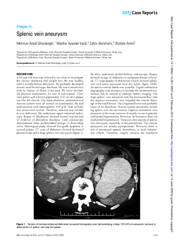(PDF) Splenic vein aneurysm