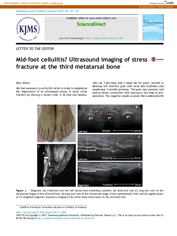 (PDF) Mid-foot cellulitis? Ultrasound imaging of stress fracture at the ...