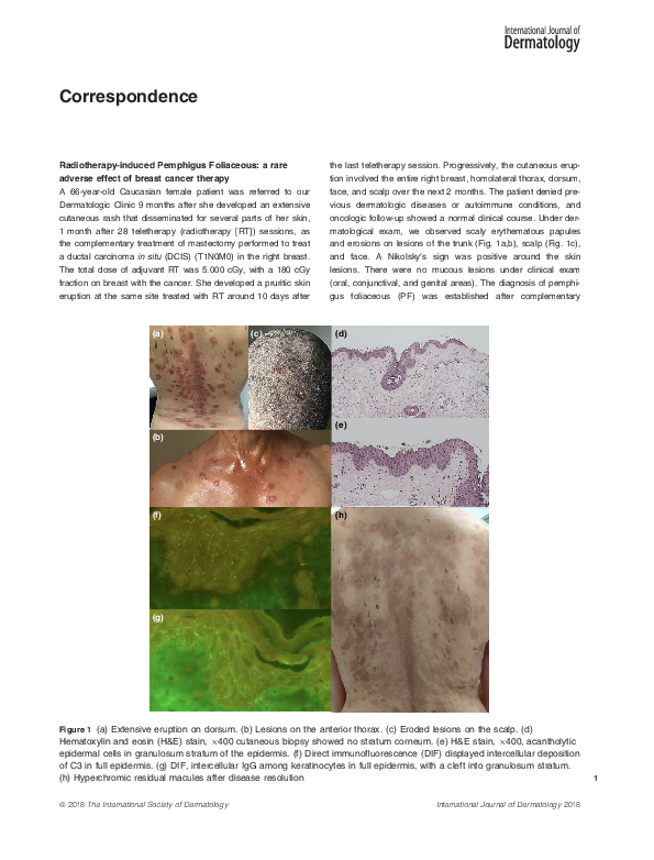 (PDF) Radiotherapy-induced Pemphigus Foliaceous: a rare adverse effect ...