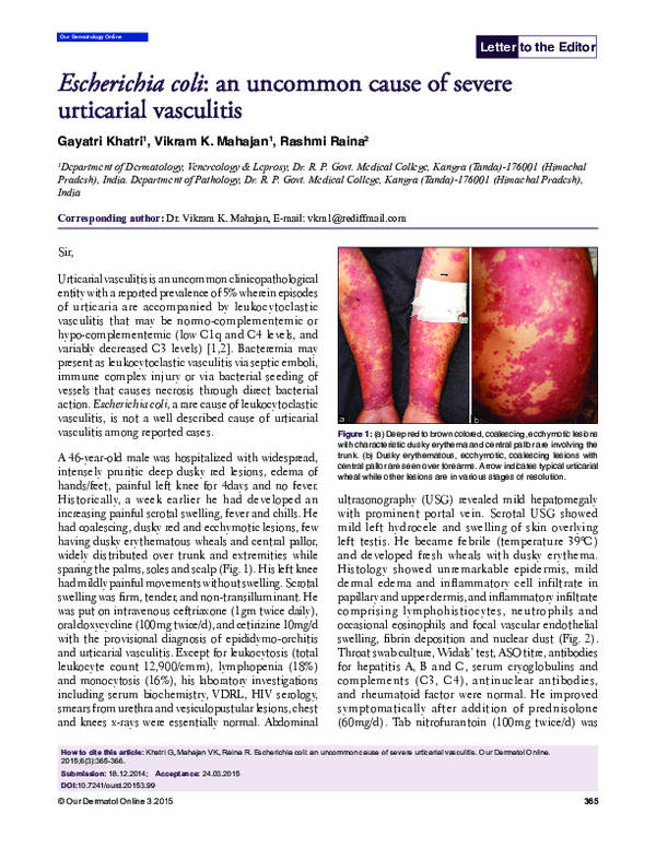 (PDF) Escherichia coli: an uncommon cause of severe urticarial vasculitis