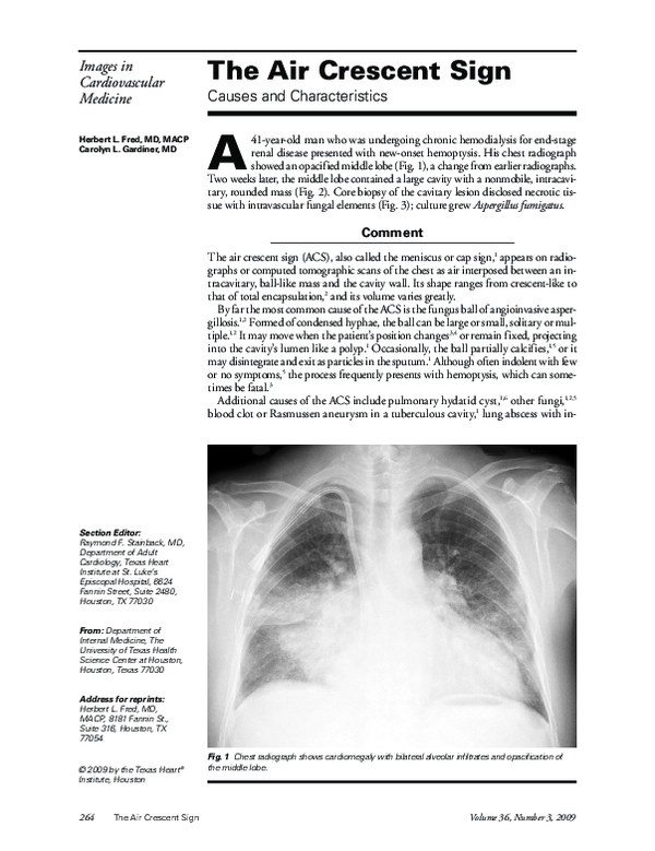 (PDF) The air crescent sign: causes and characteristics
