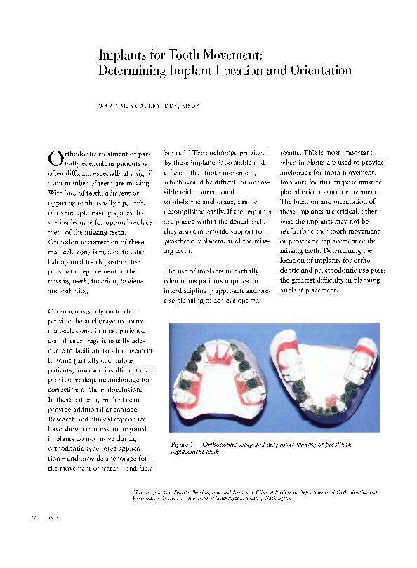 (PDF) Implants for Tooth Movement: Determining Implant Location and ...