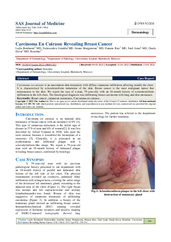 (PDF) Carcinoma En Cuirasse Revealing Breast Cancer