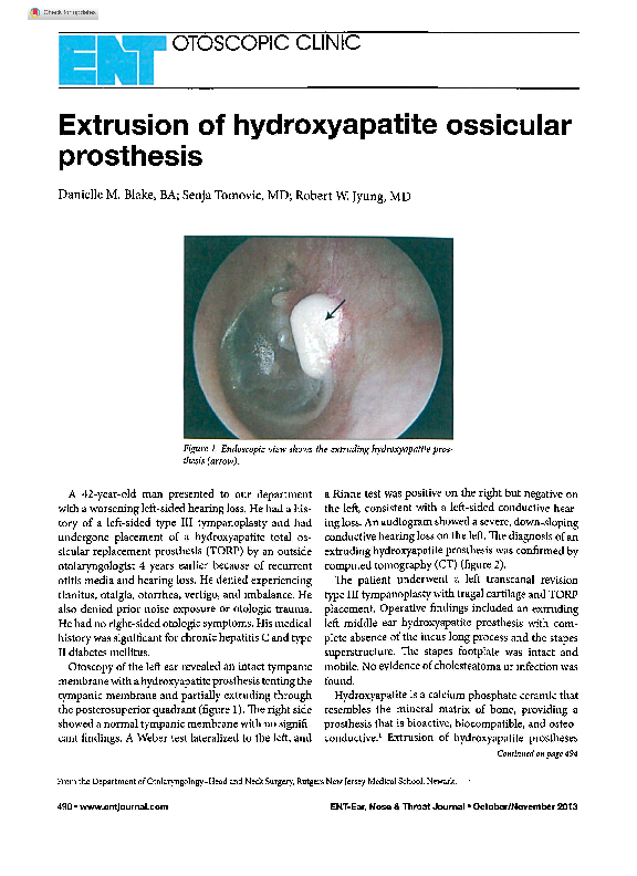 (PDF) Extrusion of Hydroxyapatite Ossicular Prosthesis