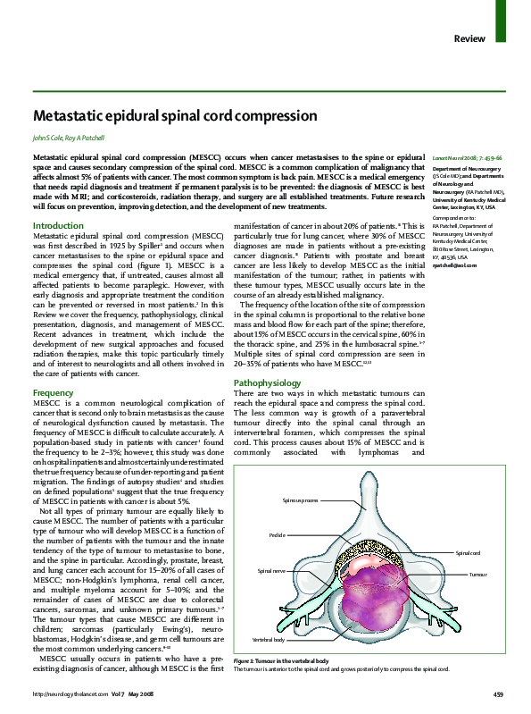 (PDF) Metastatic epidural spinal cord compression