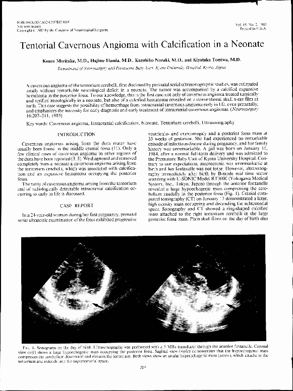 (PDF) Tentorial Cavernous Angioma with Calcification in a Neonate