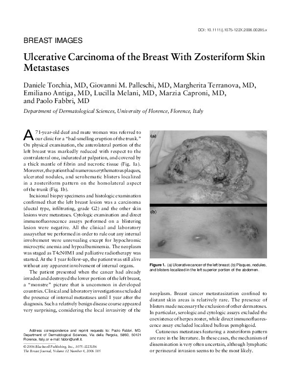 (PDF) Ulcerative Carcinoma of the Breast With Zosteriform Skin Metastases