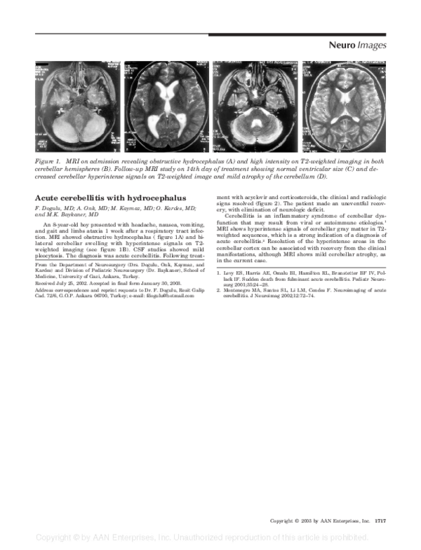 (PDF) Acute cerebellitis with hydrocephalus