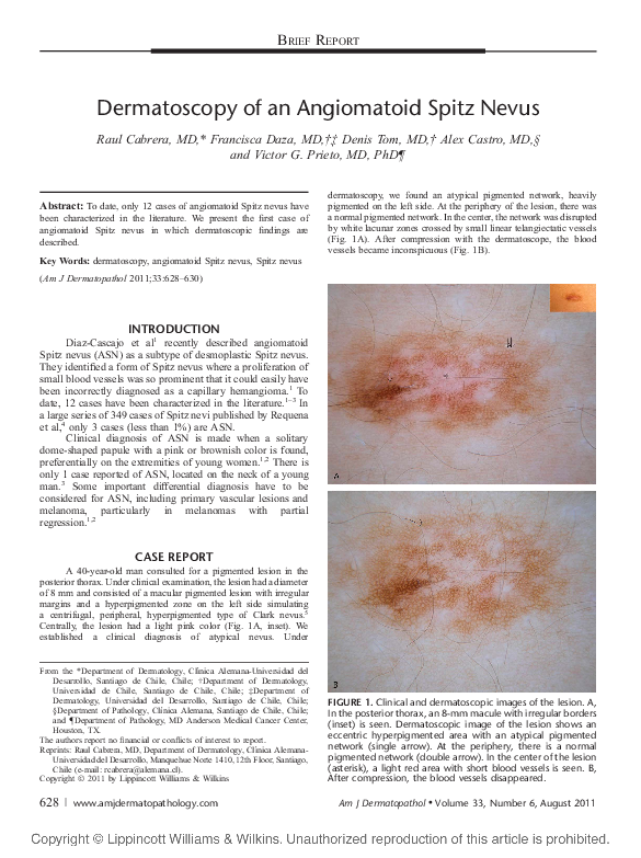 (PDF) Dermatoscopy of an Angiomatoid Spitz Nevus