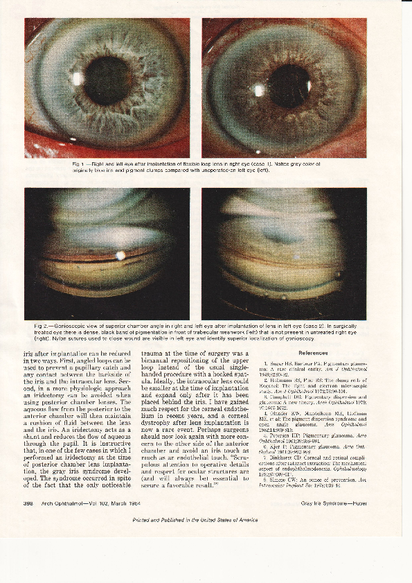 (PDF) The Gray Iris Syndrome
