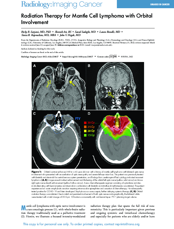 (PDF) Radiation Therapy for Mantle Cell Lymphoma with Orbital Involvement