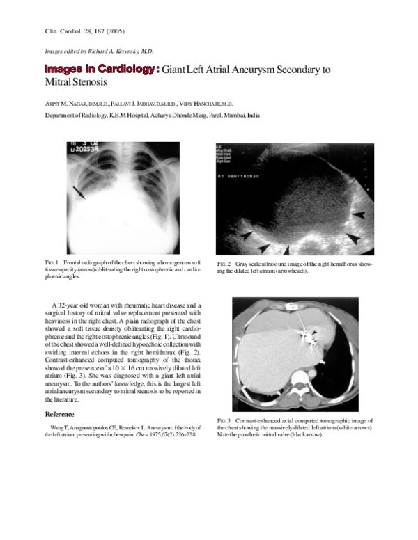 (PDF) Giant left atrial aneurysm secondary to mitral stenosis