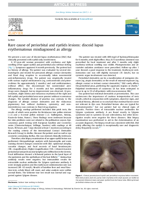 (PDF) Rare cause of periorbital and eyelids lesions: Discoid lupus ...