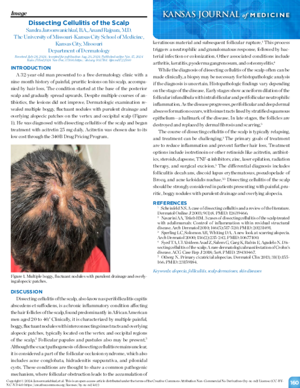 (PDF) Dissecting Cellulitis of the Scalp