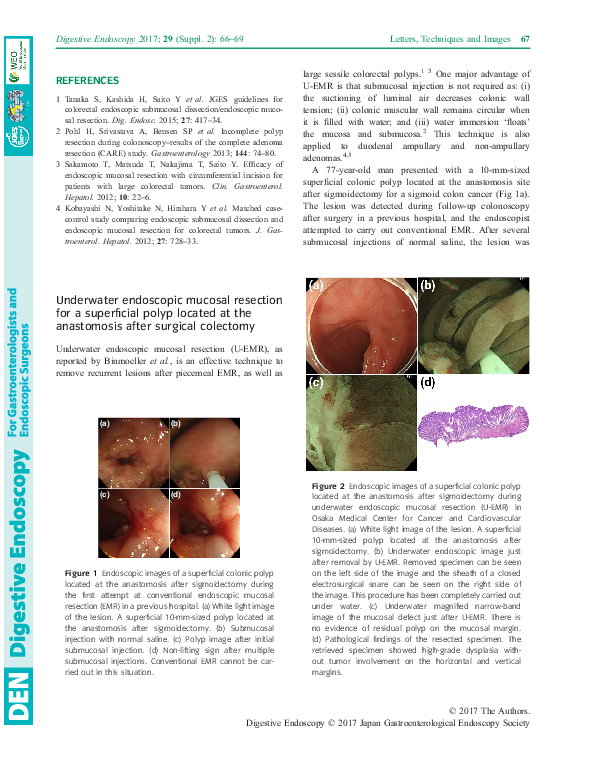 (PDF) Underwater endoscopic mucosal resection for a superficial polyp ...