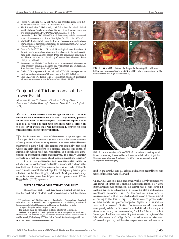 (PDF) Conjunctival Trichodiscoma of the Lower Eyelid