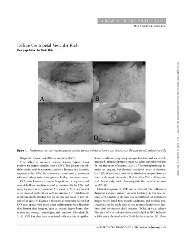 (PDF) Diffuse Centripetal Vesicular Rash