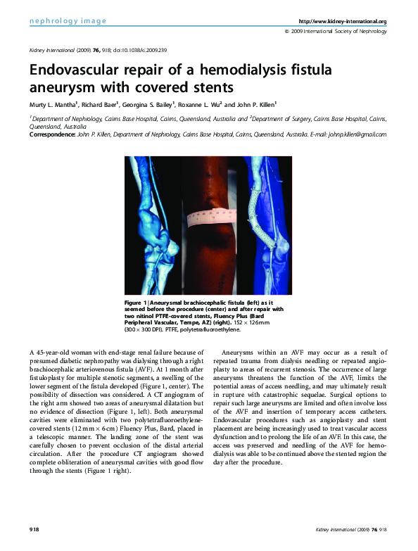 (PDF) Endovascular repair of a hemodialysis fistula aneurysm with ...