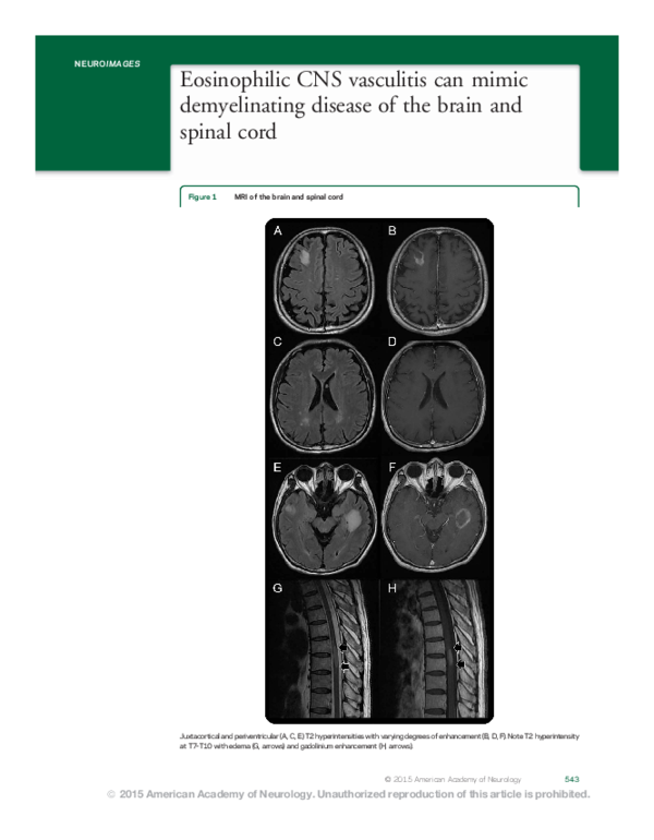 (PDF) Eosinophilic CNS vasculitis can mimic demyelinating disease of the brain and spinal cord