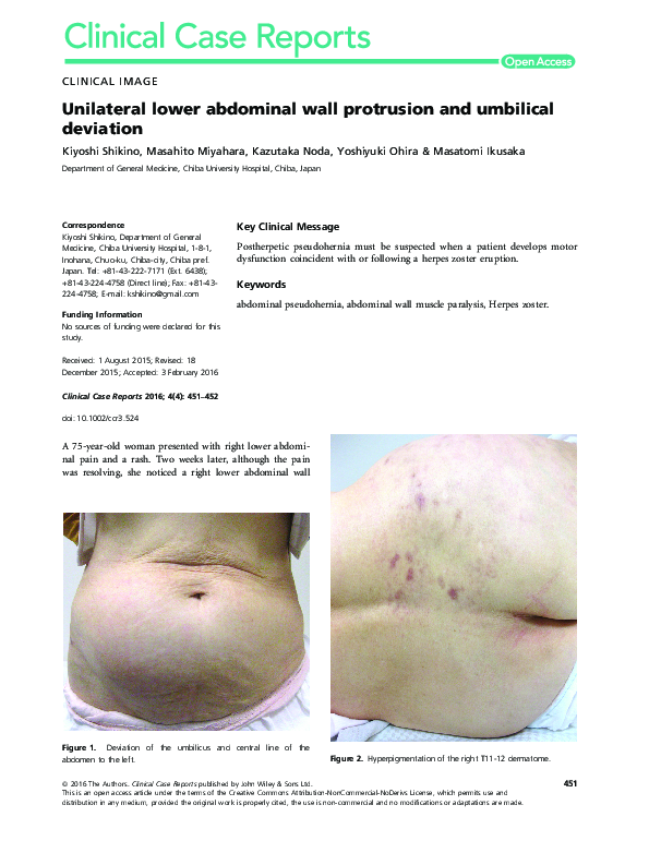 (PDF) Unilateral lower abdominal wall protrusion and umbilical deviation