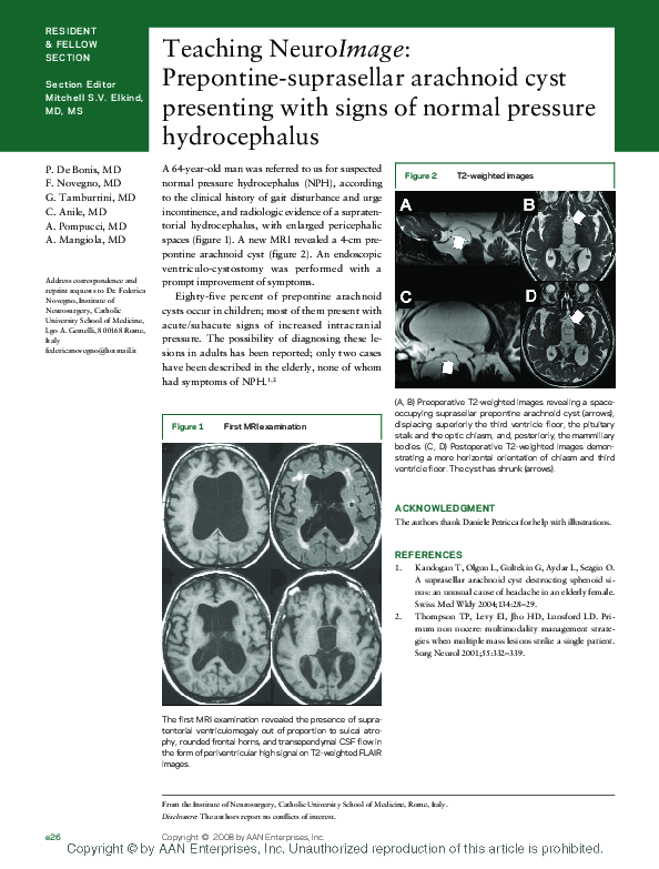 (PDF) Teaching NeuroImage: Prepontine-suprasellar arachnoid cyst ...