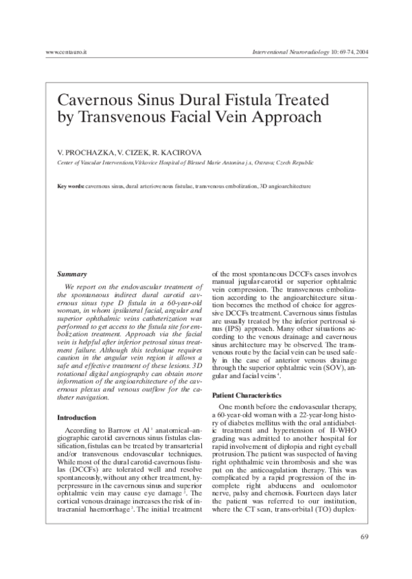 (PDF) Cavernous Sinus Dural Fistula Treated by Transvenous Facial Vein Approach