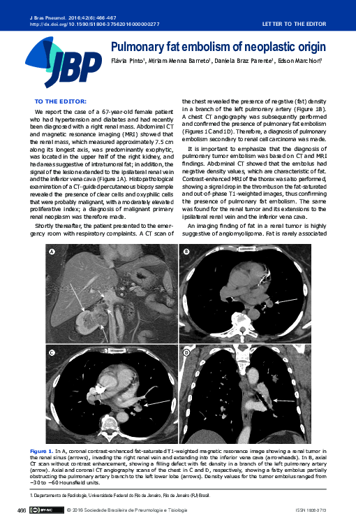 (PDF) Pulmonary fat embolism of neoplastic origin