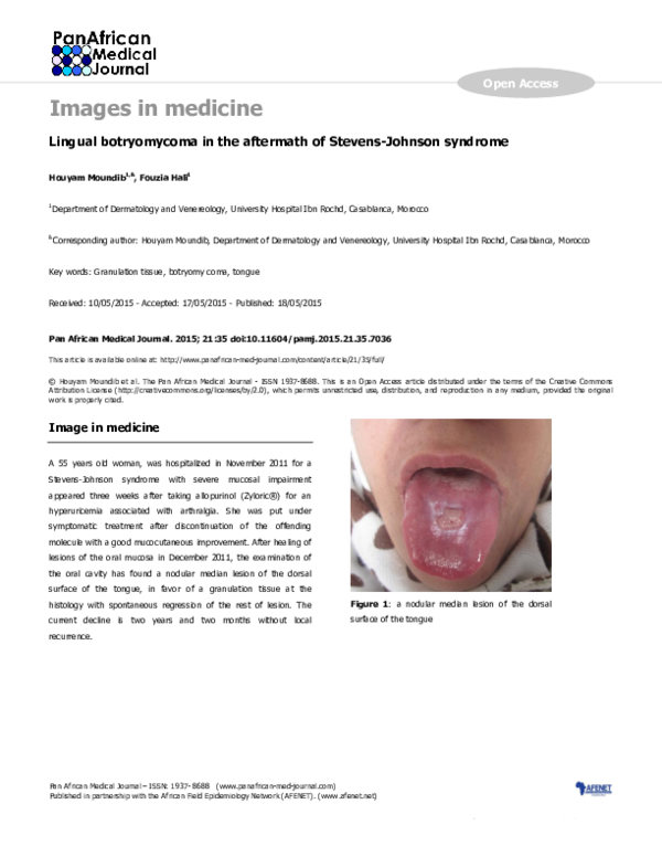 (PDF) Lingual botryomycoma in the aftermath of Stevens-Johnson syndrome