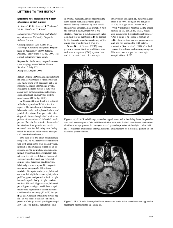 (PDF) Extensive MRI lesion in brain stem of a neuro-Behcet patient