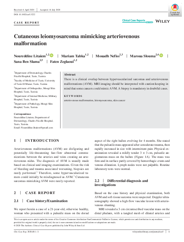 (PDF) Cutaneous leiomyosarcoma mimicking arteriovenous malformation